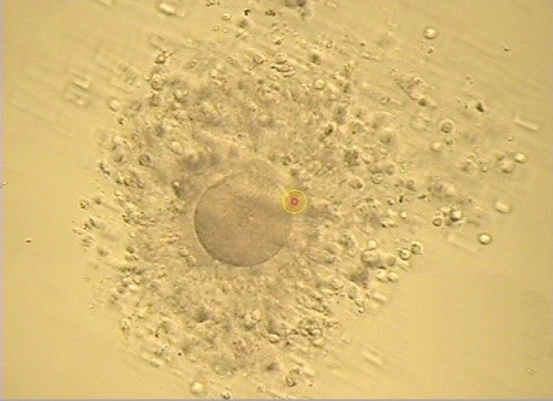 Fertilization Failure in IVF with regular insemination | Genesis ...